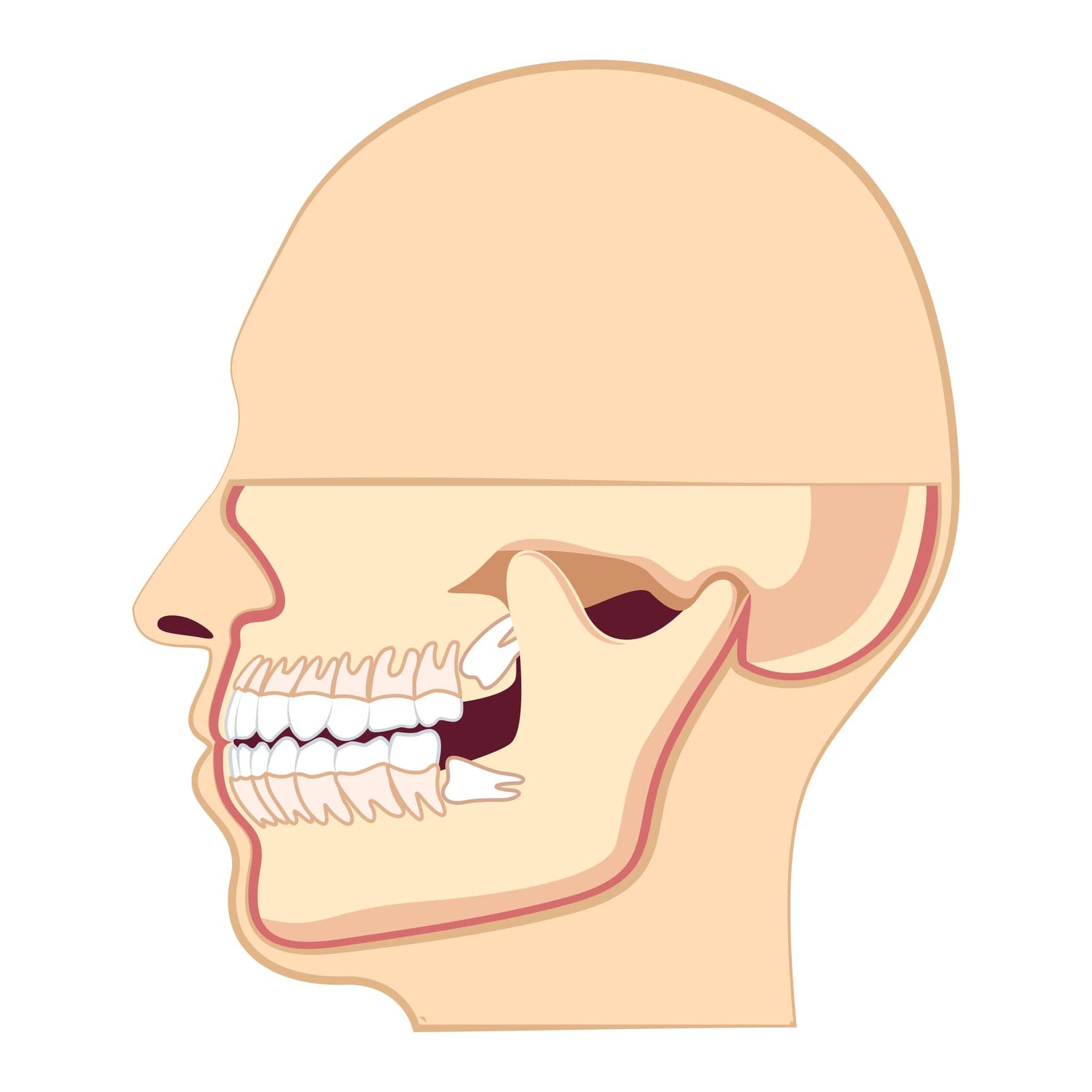 Surprising Findings on Maxillomandibular Advancement Indications