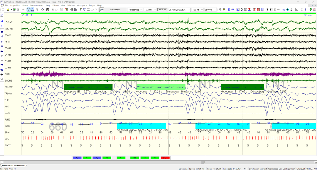 How Software Can Simplify Hypopnea Scoring for Varied Payors | Sleep Review